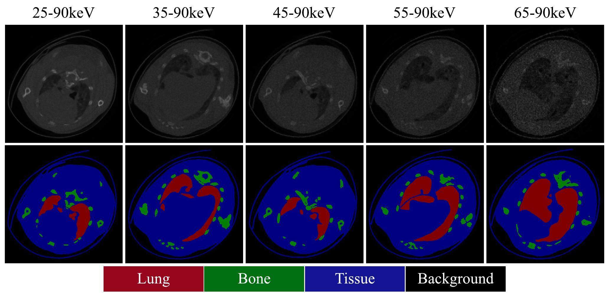 Material decomposition of spectral CT images via attention-based global ...