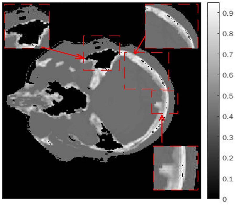 Sparse view neutron CT 3D image reconstruction algorithm based on split ...